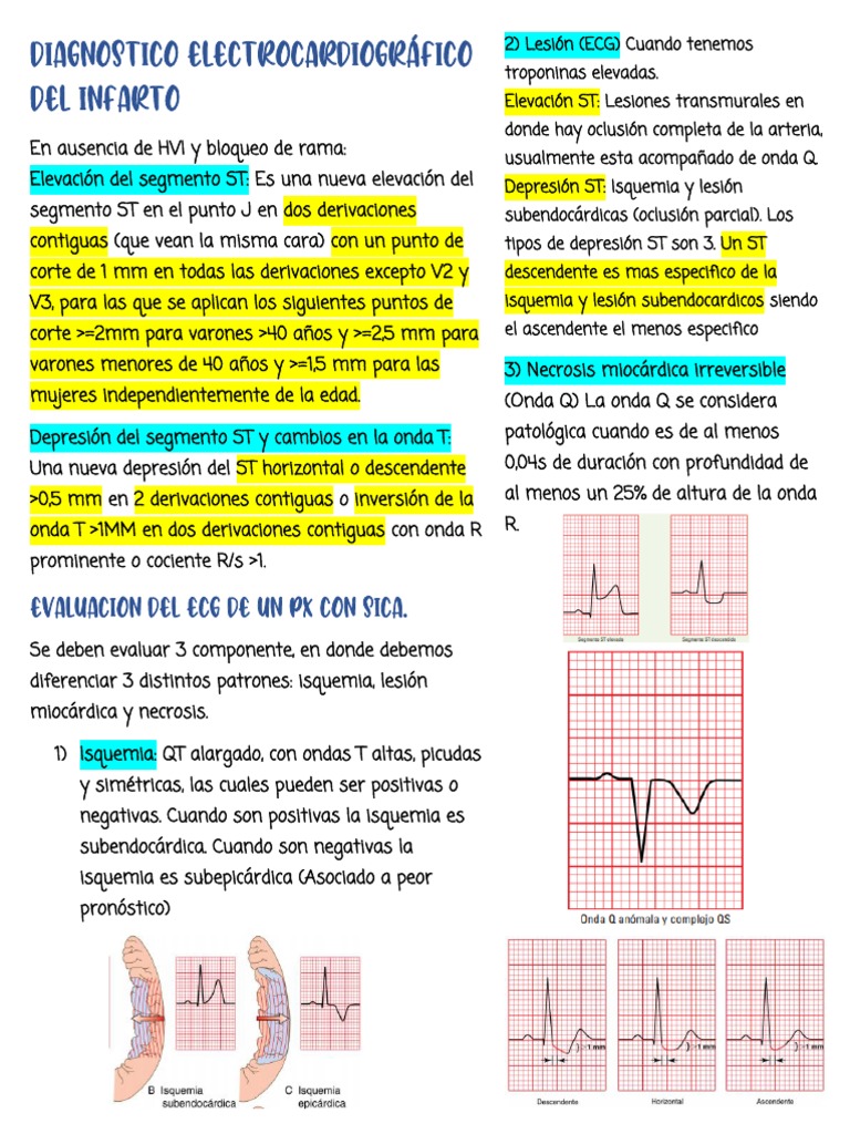 Iam Ekg | PDF | Electrocardiografia | Infarto de miocardio
