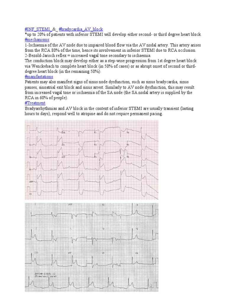 #Inf - Stemi - #Bradycardia - AV - Block #Mechanisms | PDF