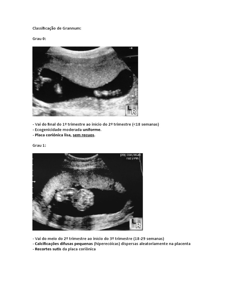 Classificação da Placenta por Grannum | PDF