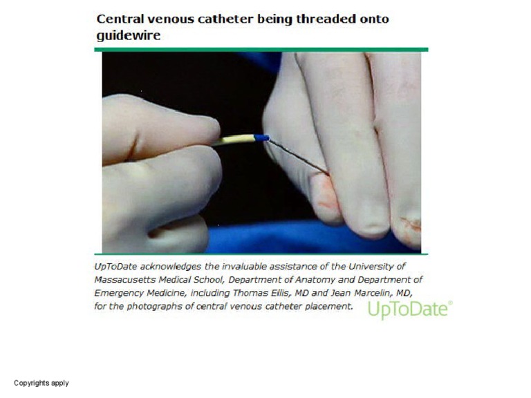 Central Venous Catheter Being Threaded Onto Guidewire | PDF