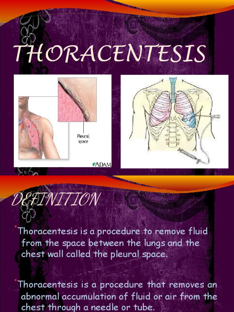 Thoracentesis - Paracentesis | PDF | Diseases And Disorders | Clinical ...