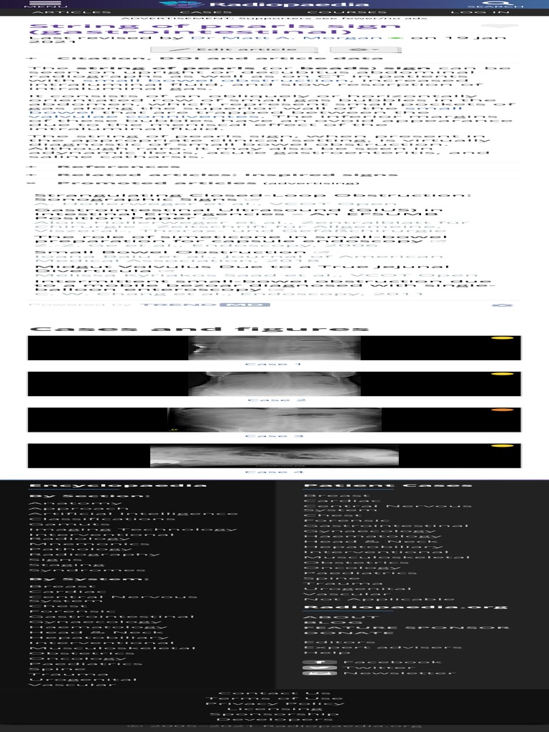 String of Pearls Sign (Gastrointestinal) Radiology Reference Article | PDF