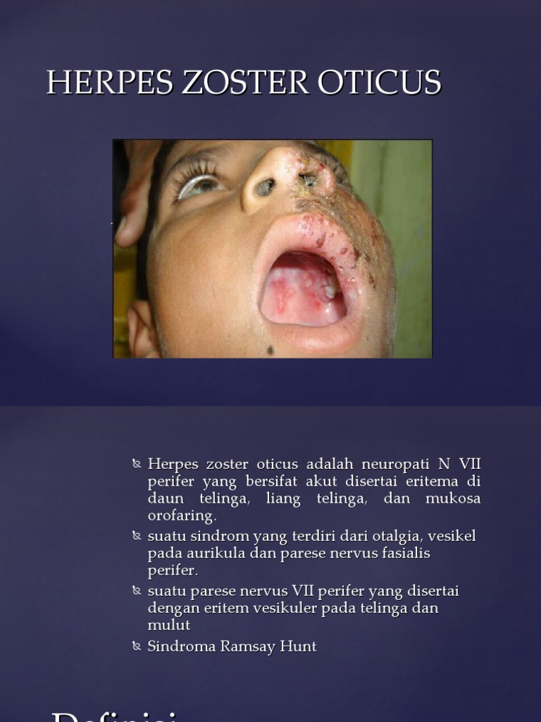 Herpes Zooster Otikus | PDF