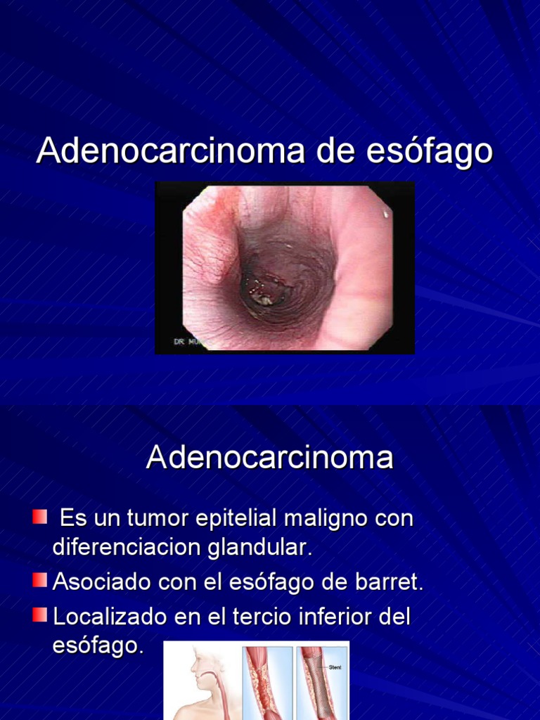 Adenocarcinoma de Esófago | PDF | Cáncer de esófago | Cáncer