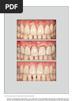 Classification of Dental Surface Defects in Areas of Gingival Recession ...