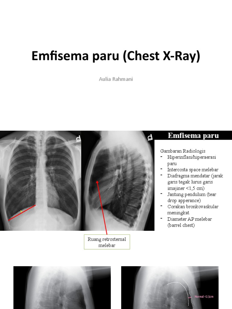 Emfisema Paru (Chest X-Ray) | PDF