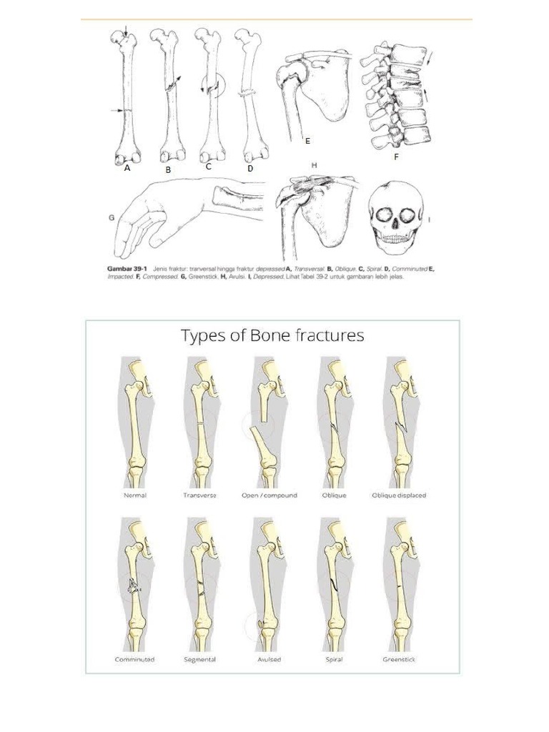 Gambar Tipe Fraktur | PDF