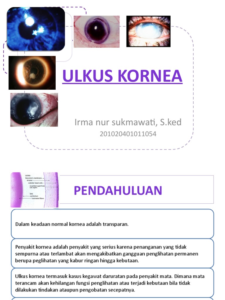 Ulkus Kornea | PDF