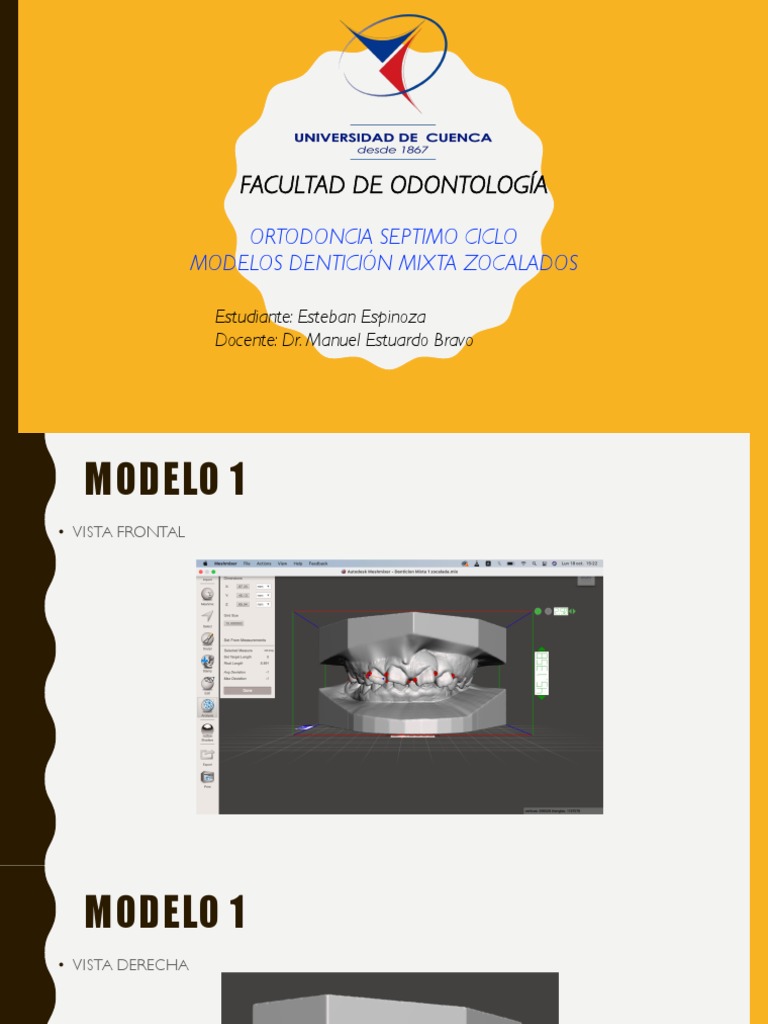 Modelos Denticion Mixta Zocalados Moyers y TJ | PDF