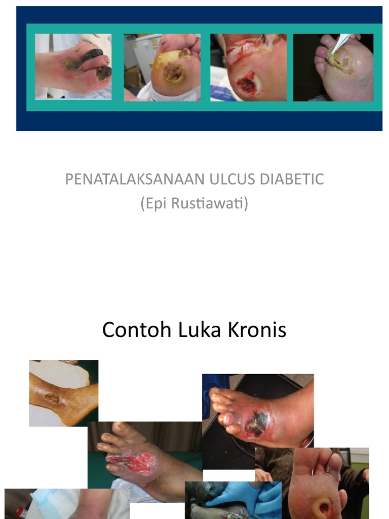 Ulcus Diabetikum | PDF