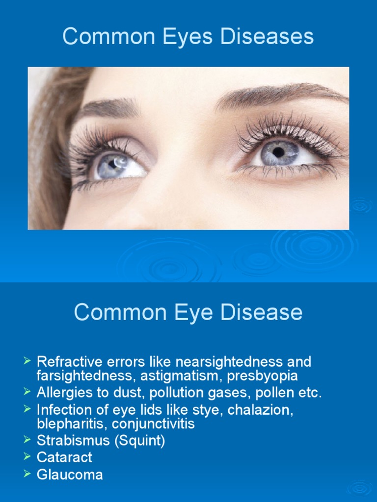 Common Eye Diseases | PDF | Glaucoma | Senses
