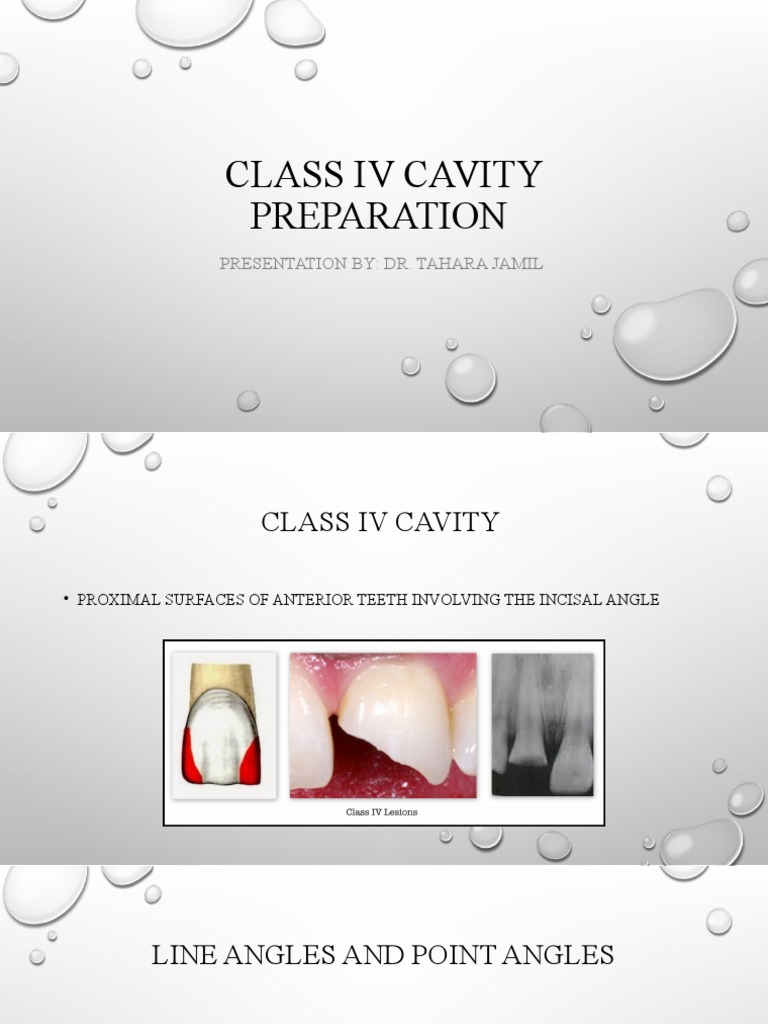 Class Iv Cavity Preparation: Presentation By: Dr. Tahara Jamil | PDF