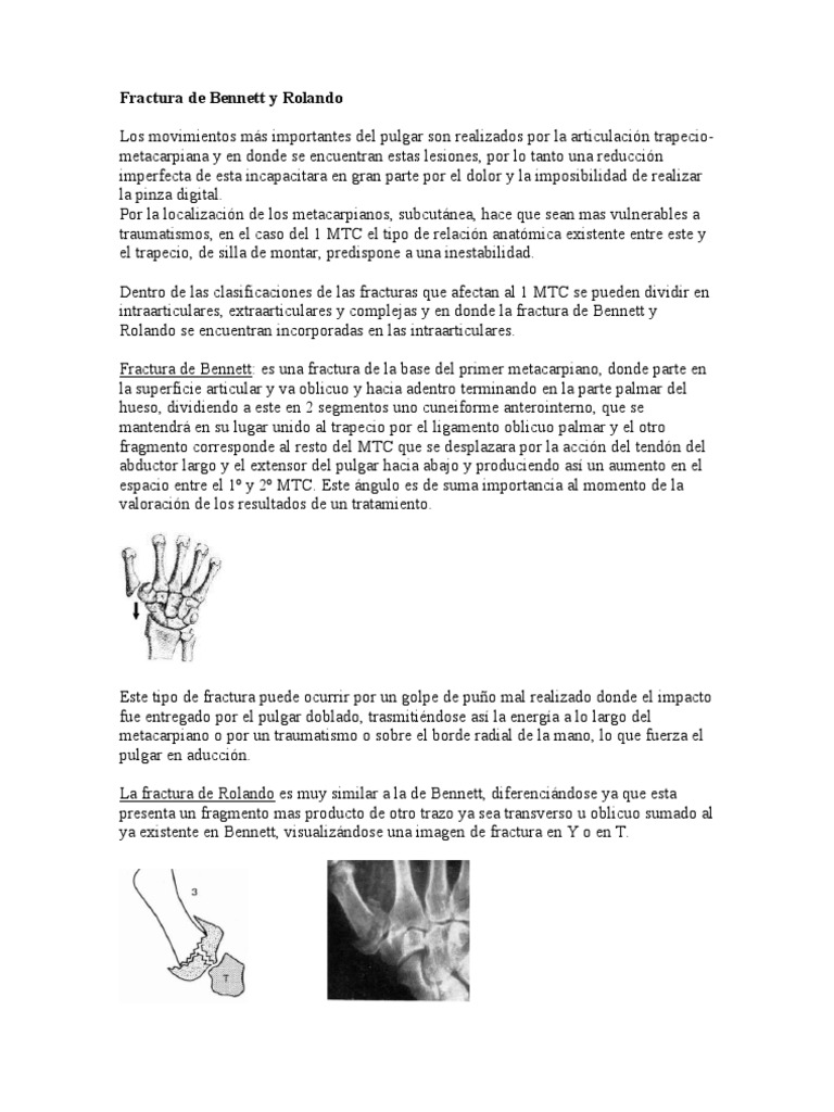 Fractura de Bennett y Rolando | PDF | Mano | Sistema esquelético