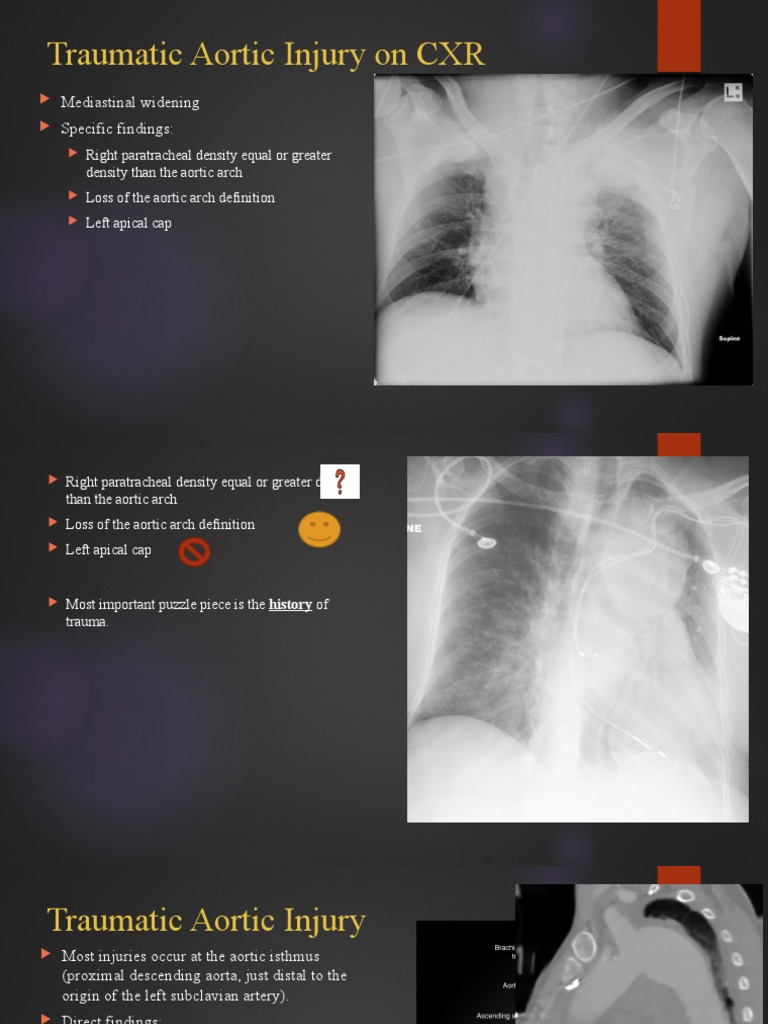 Traumatic Aortic Injury Indicators | PDF