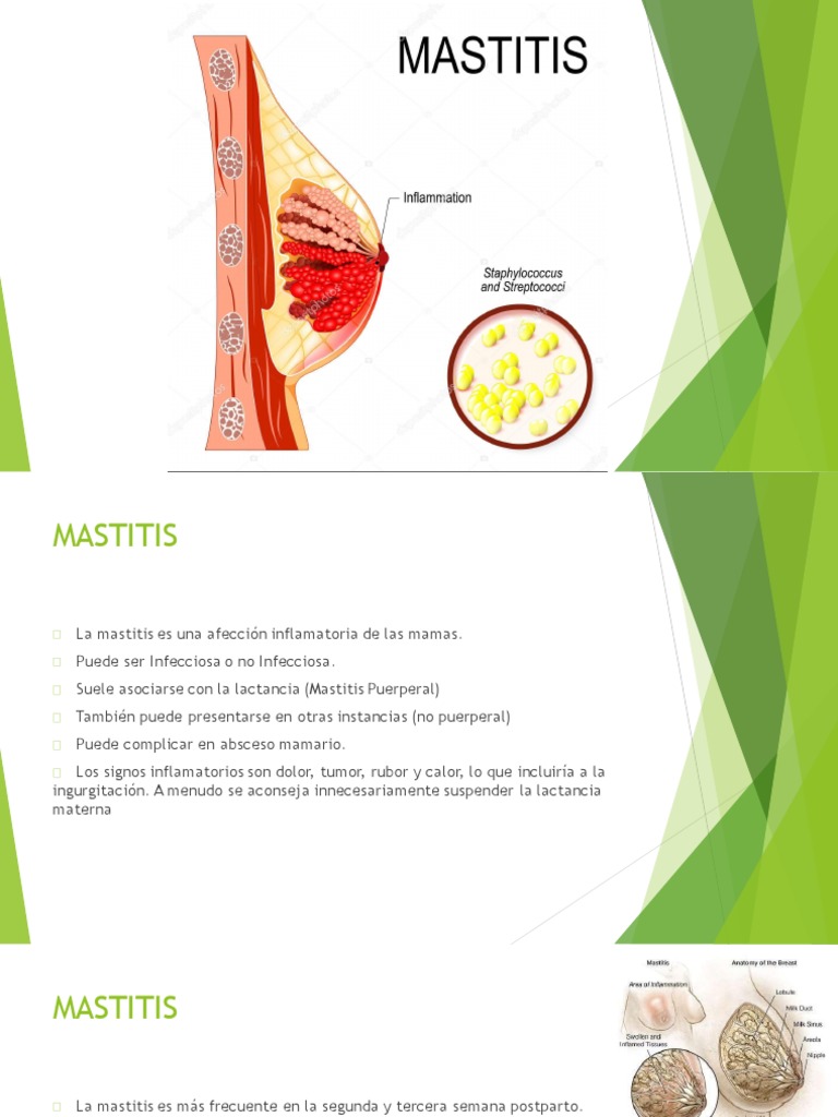 Mastitis: Causas, Síntomas y Tratamiento | PDF | Pecho | Leche