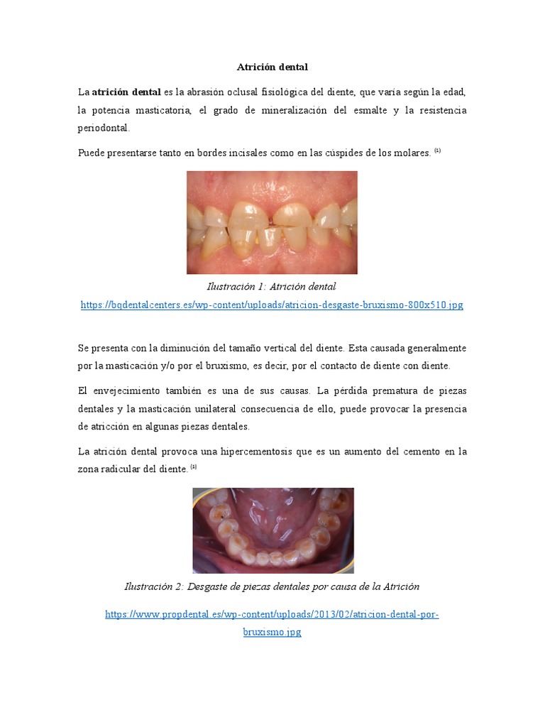 Atrición Dental | PDF | Diente | Odontología
