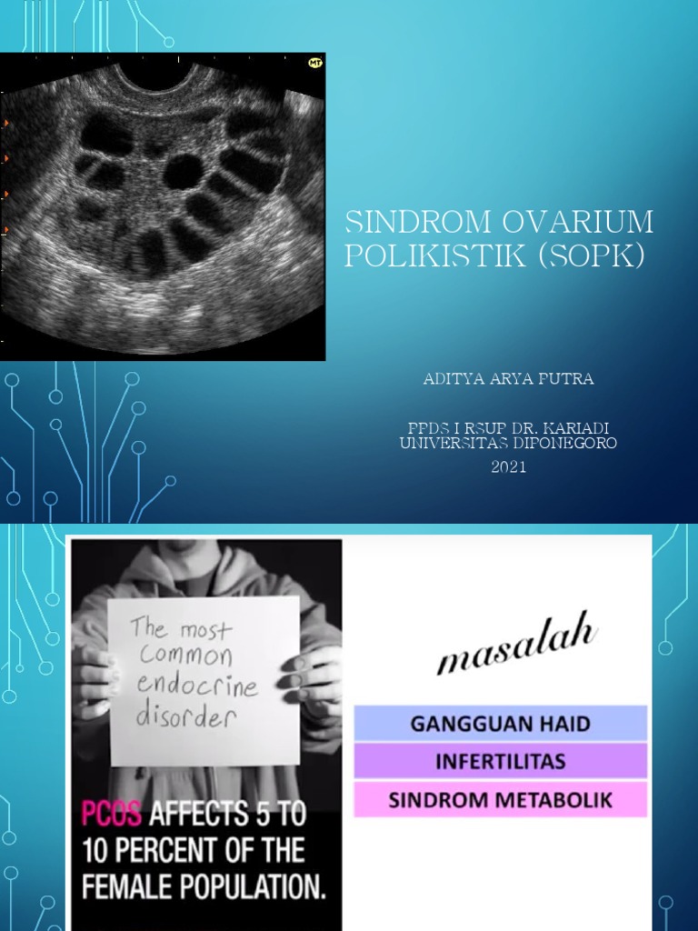 Sindrom Ovarium Polikistik (Sopk) : Aditya Arya Putra | PDF ...