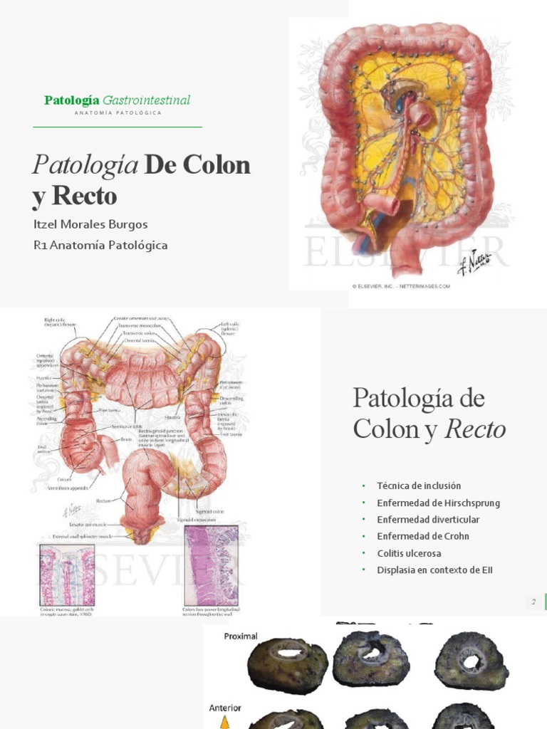 Patología de Colon y Recto | PDF | Enfermedad de Crohn | Inflamación