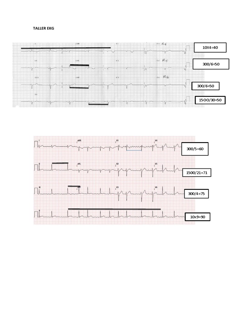 Taller Ekg 1 1 | PDF