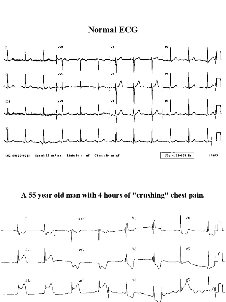 ECG Case Studies | PDF | Cardiac Electrophysiology | Cardiovascular System
