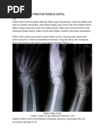 Fraktur Antebrachii: Diagnosis dan Pengobatan | PDF