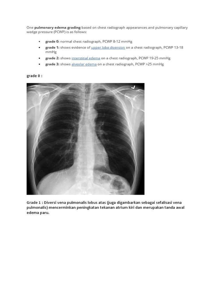 Edema Pulmonum Grading | PDF