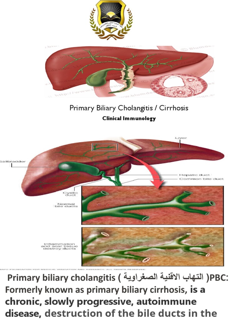 Overview Of Primary Biliary Cholangitis Pdf Cirrhosis Liver