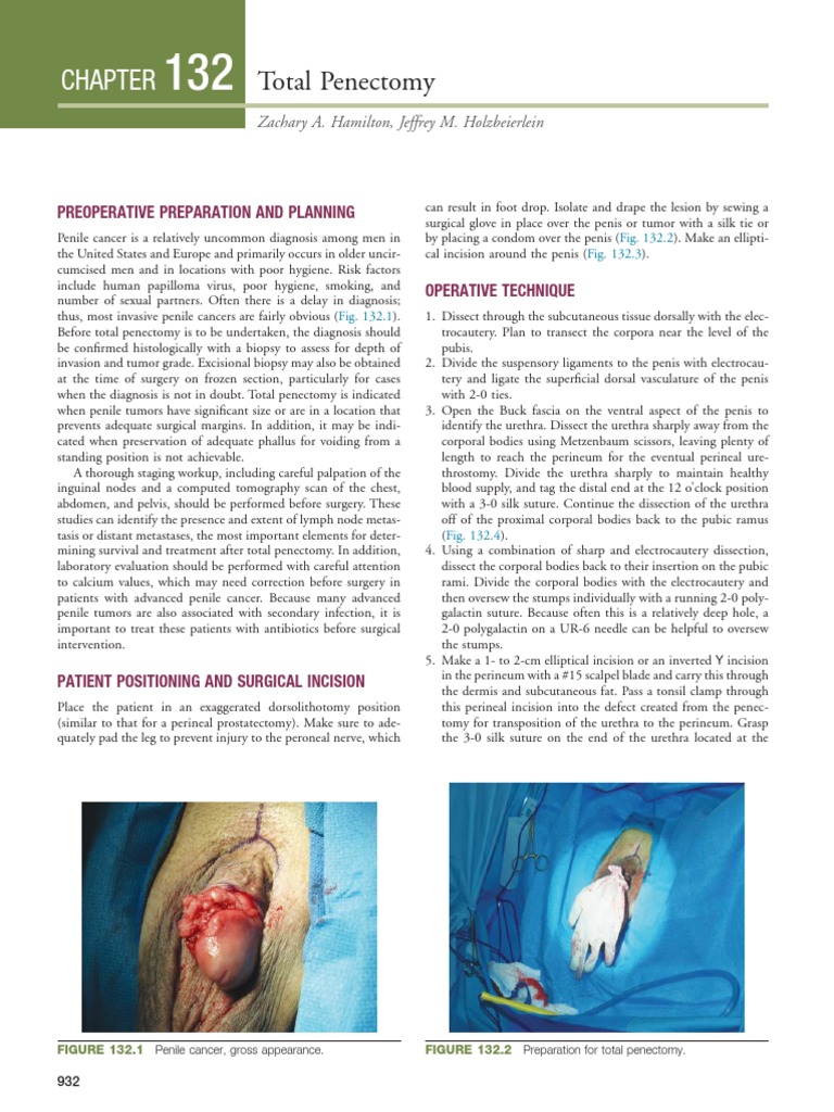 Chapter 132 Total Penectomy. Hinman. 4th Ed. 2017 | PDF | Medical ...