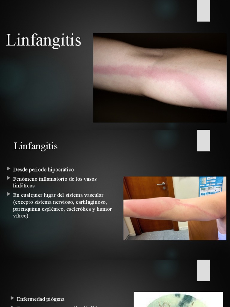 Linfangitis | Descargar gratis PDF | Linfoma | Biología