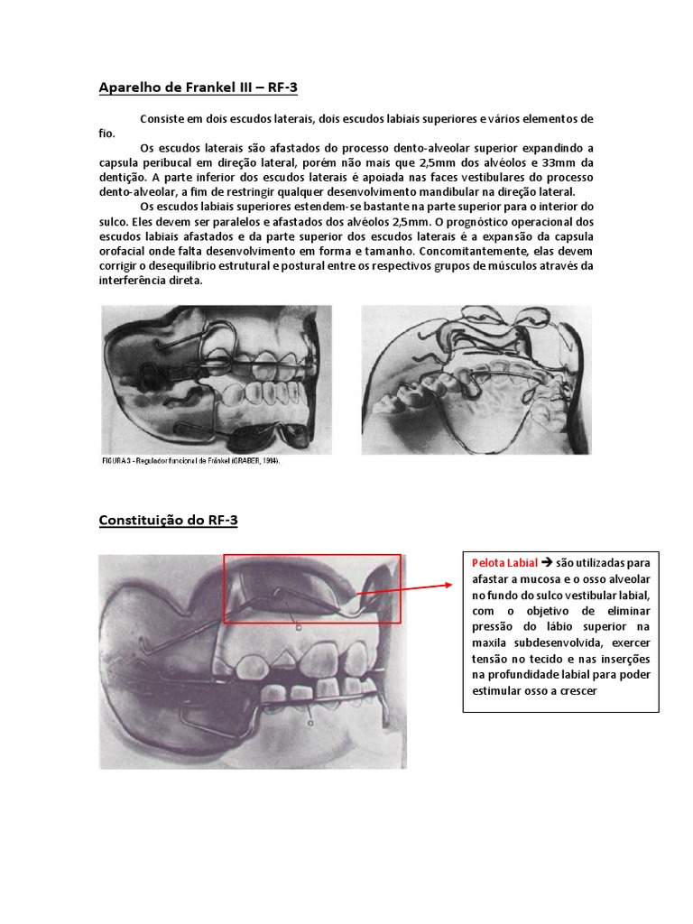 Aparelho Frankel III: Indicações e Ação | PDF | Dente