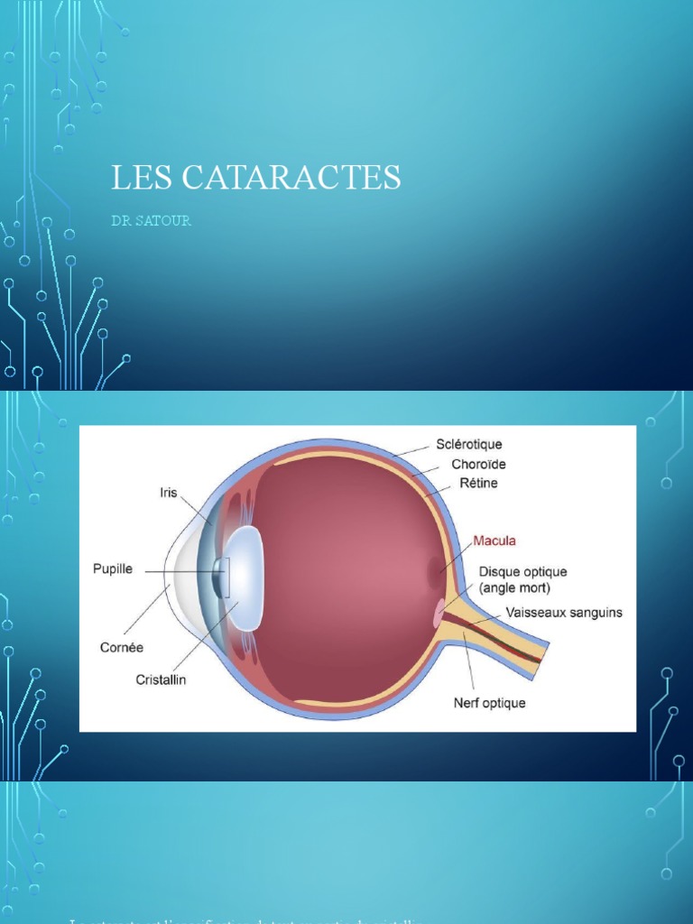 Types et traitement des cataractes | PDF | Cataracte | Acuité visuelle