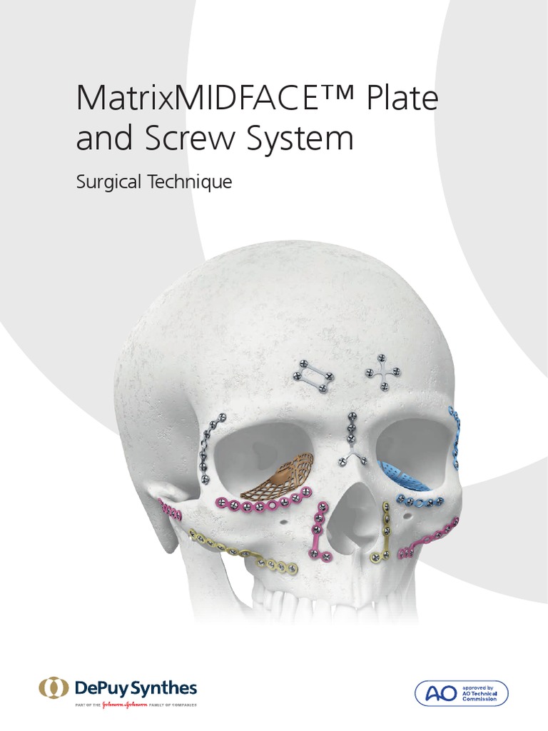 Matrixmidface™ Plate and Screw System: Surgical Technique | PDF | Screw ...