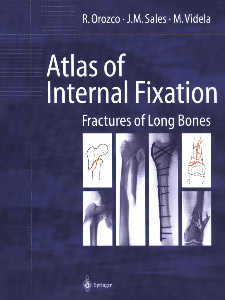 Atlas of Internal Fixation - Fractures of Long Bones. Classification ...