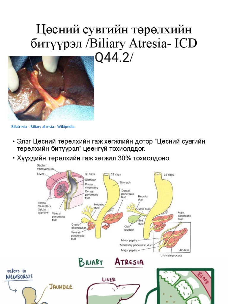 Цөсний сувгийн төрөлхийн битүүрэл Pdf