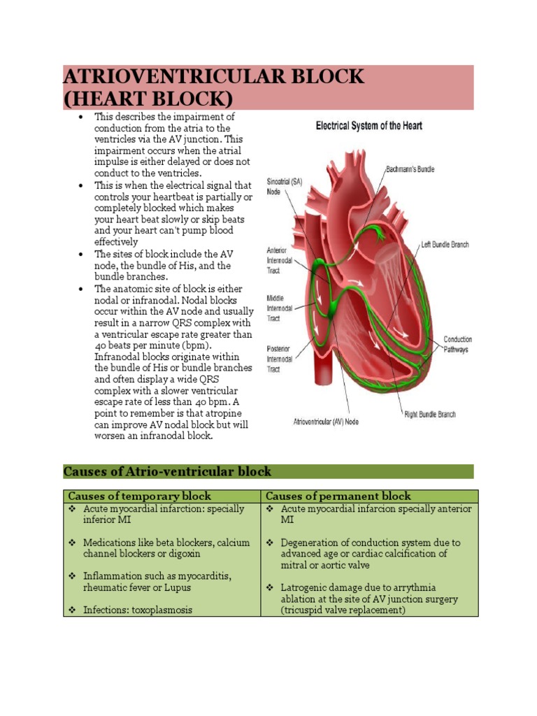 Atrioventricular Block (Heart Block) : Causes of Atrio-Ventricular ...
