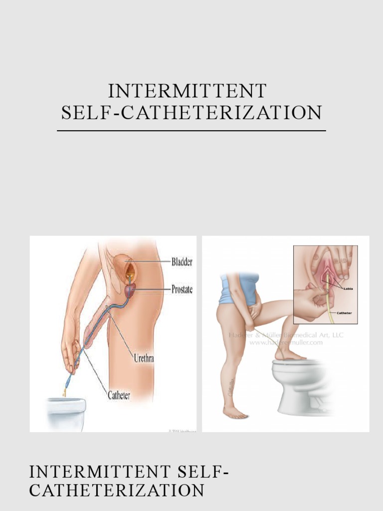 Intermittent Self-Catheterization | PDF | Medicine | Genitourinary System