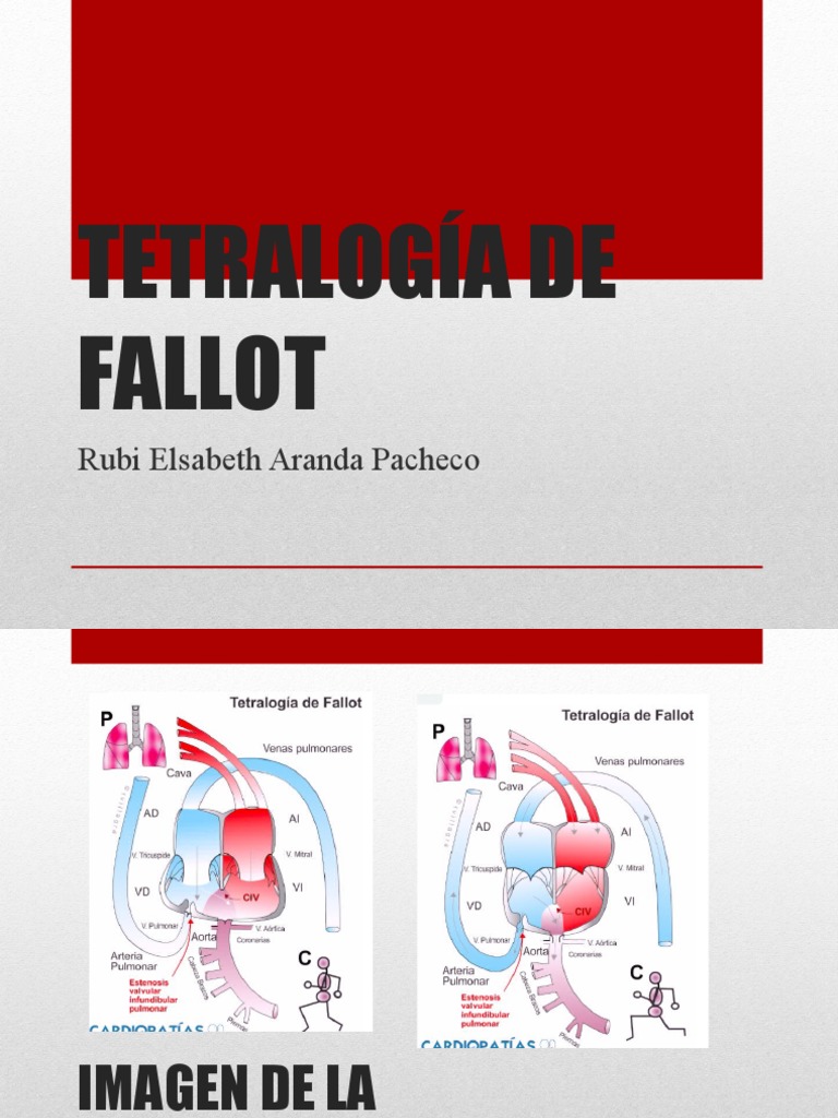Tetralogia de Fallot | PDF | Corazón | Defecto cardiaco congenito