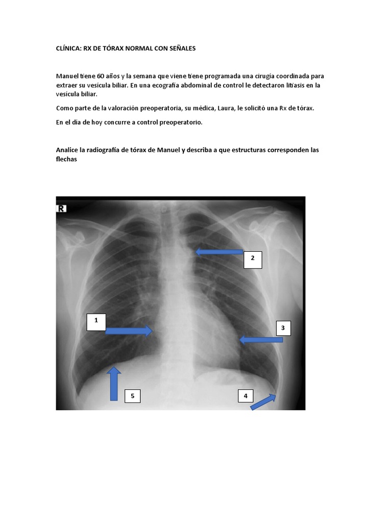 Clínica RX Tórax Normal Con Señales | PDF | Tórax | Especialidades Medicas