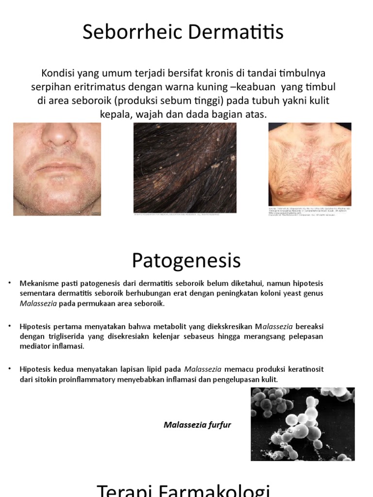 Tatalaksana Dermatitis Seboroik | PDF | Kesehatan Holistik