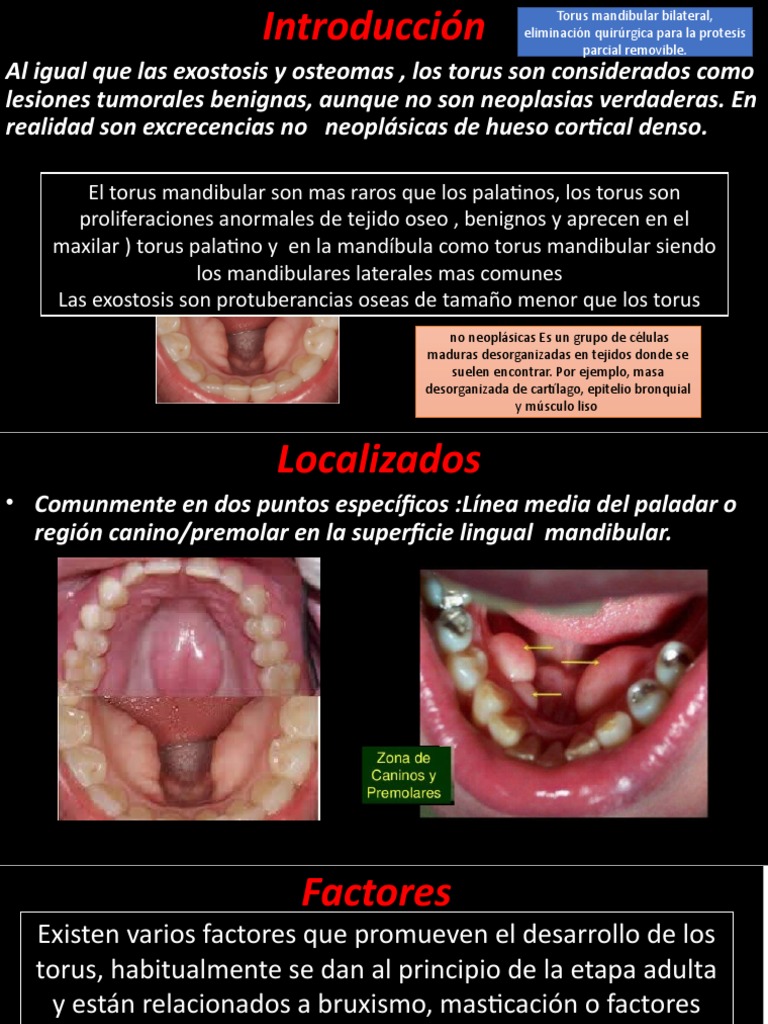 Caso Clinico - Torus Mandibular | PDF | Dentadura postiza | Neoplasias