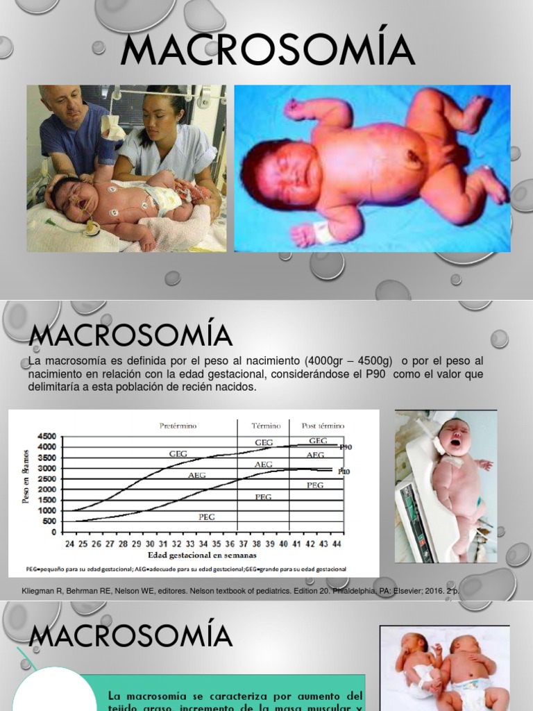 MACROSOMIA | PDF | El embarazo | Hipoglucemia