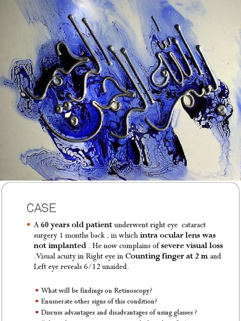 Aphakia and Ectopia Lentis Overview | PDF | Cataract | Light
