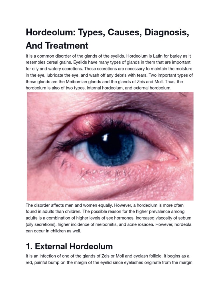 Hordeolum - Types, Causes, Diagnosis, and Treatment | PDF | Medical ...