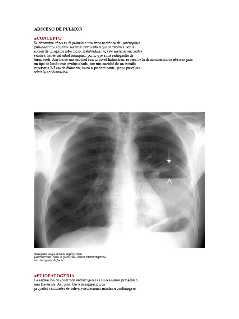 Absceso de Pulmón | PDF | Tuberculosis | Mycobacterium