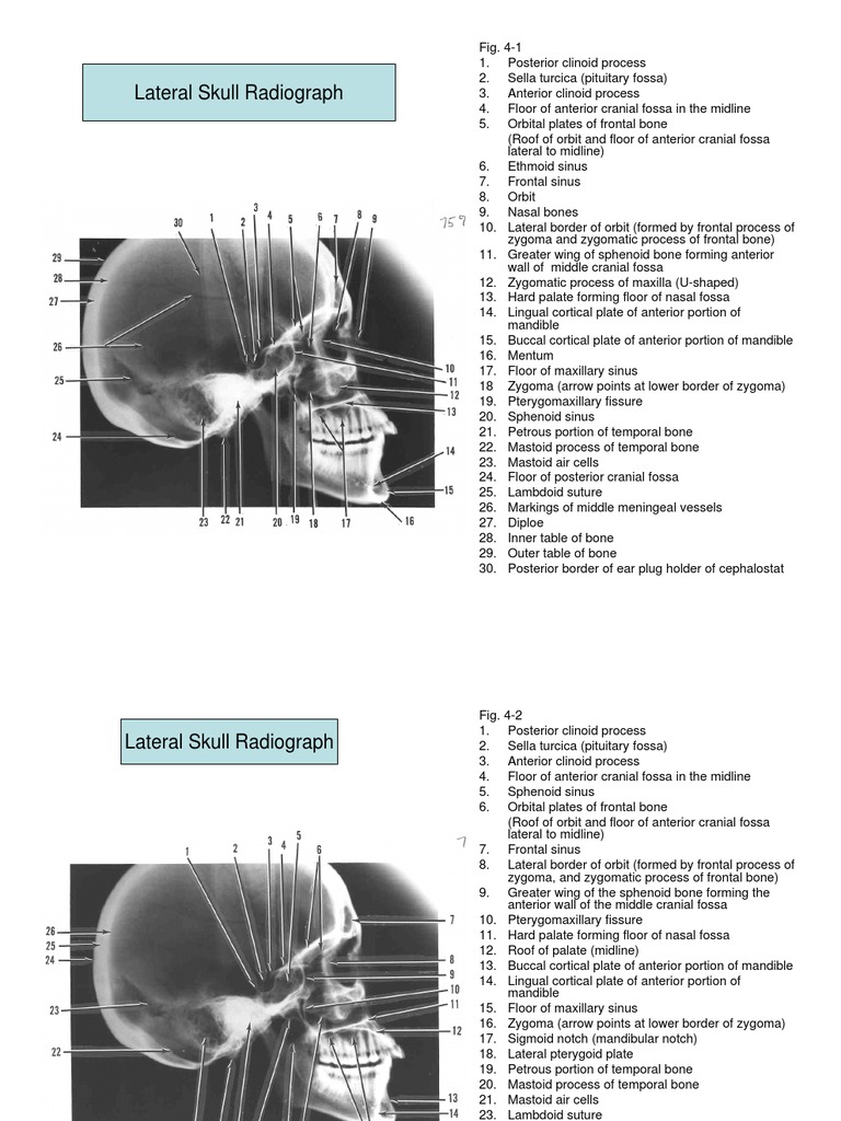 Chapter 04 Extraoral and Occlusal Anatomic Landmarks | Skull ...