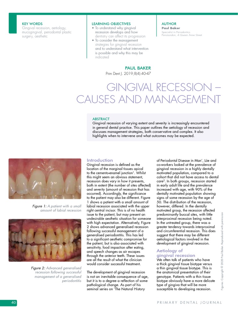 Gingival Recession - Causes and Management: Paul Baker | PDF ...