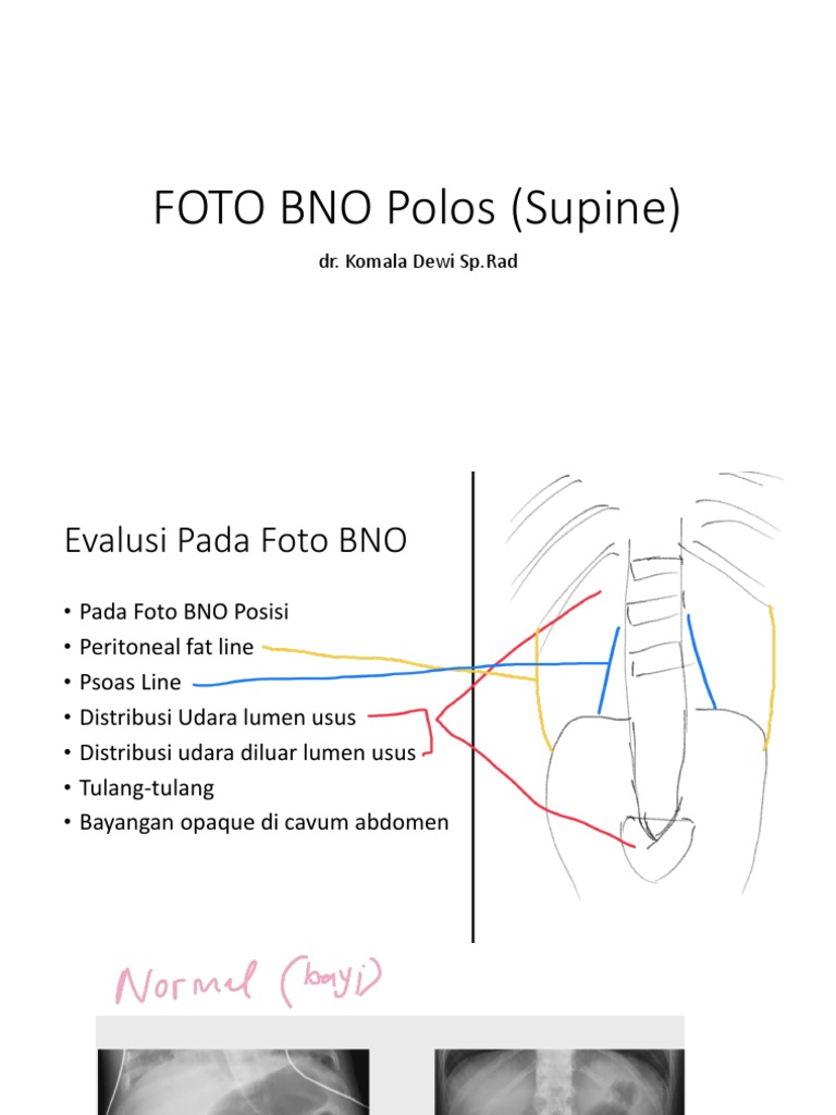Analisis Foto BNO untuk Diagnosis Abdomen | PDF