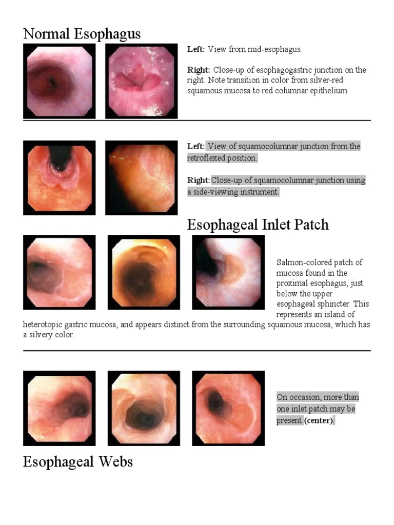 Esophageal Atlas | PDF | Esophagus | Gastroesophageal Reflux Disease