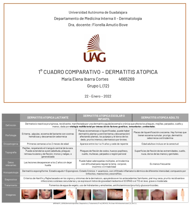 Criterios de Hanifin y Rajka en Dermatitis Atópica | PDF ...