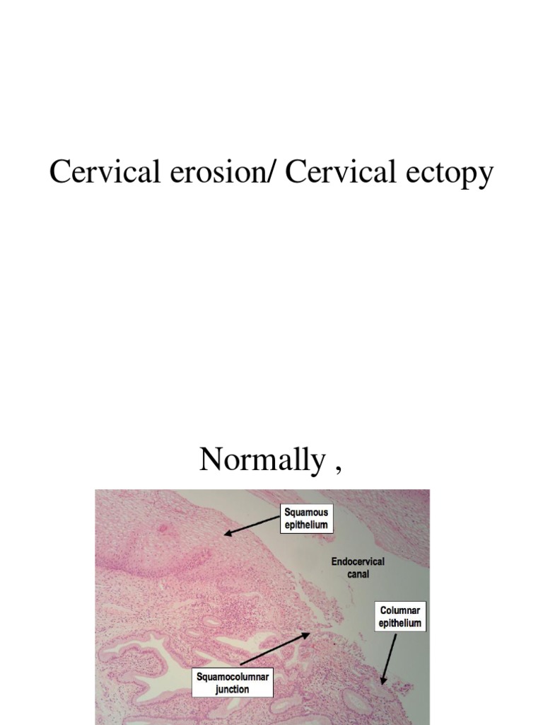 Cervical Erosion/ Cervical Ectopy | PDF | Diseases And Disorders ...